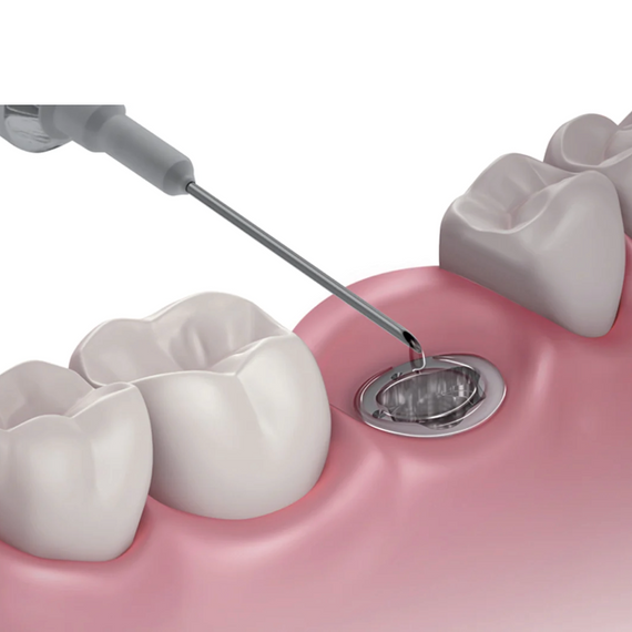 SilverPlug - Sealing Implant Systems - GP Implant LTD