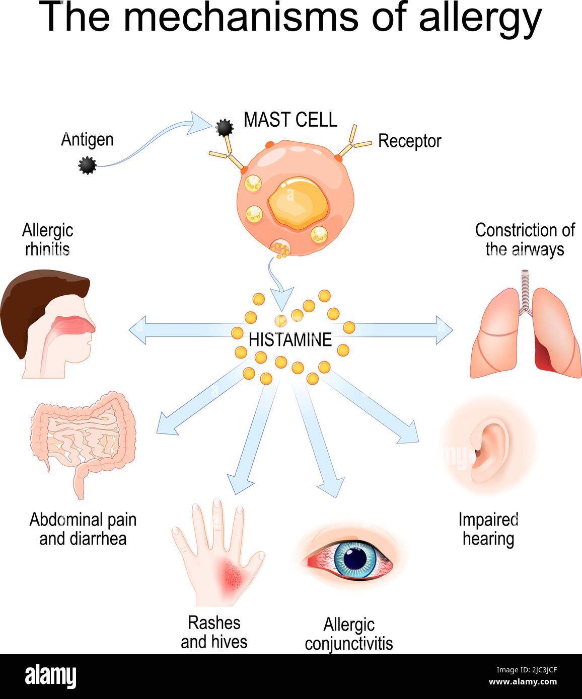Mast Cell Activation vs. Histamine Intolerance: What They Are, How They ...