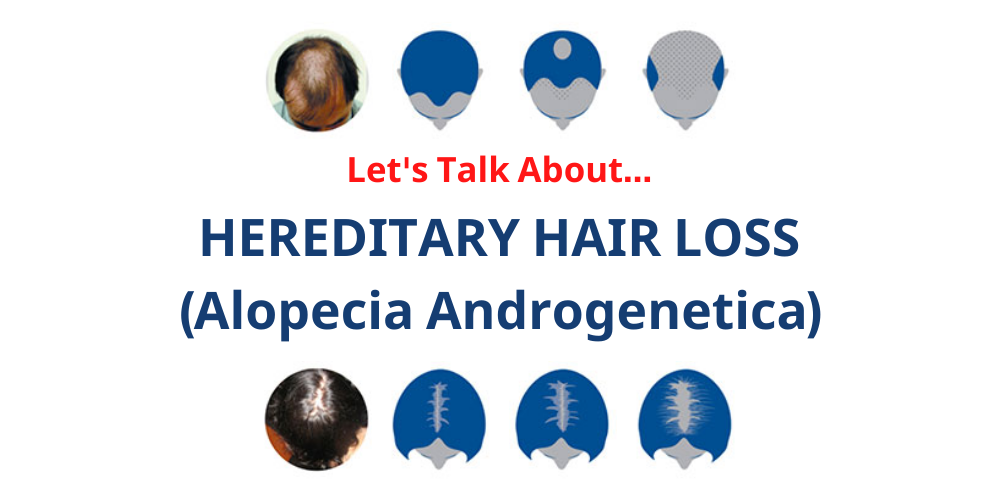 Understanding Alopecia Androgenetica: Male or Female Pattern Baldness ...