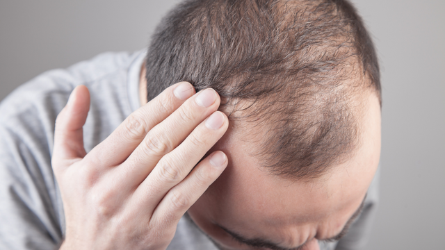 Diffuse Alopecia - Snapshot of Diffused Hair Loss - Thymuskin®
