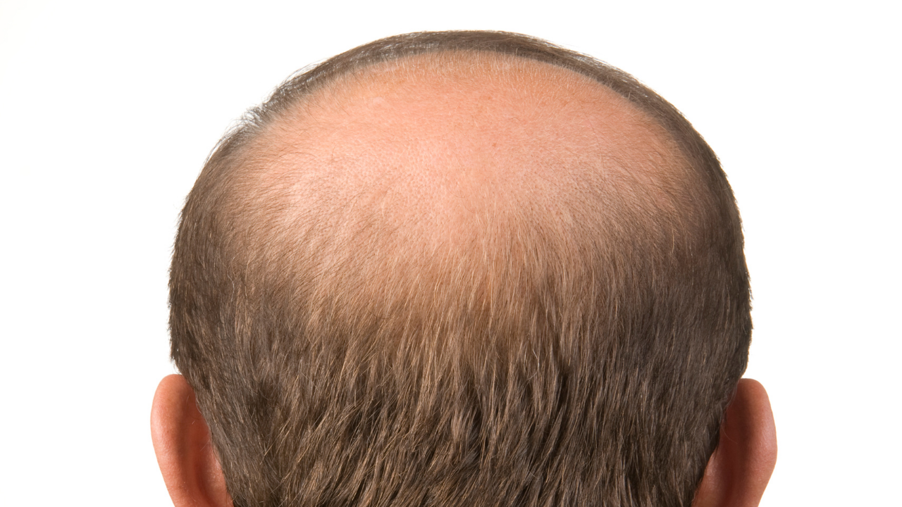 How Genetics Plays a Part in Our Hair - Thymuskin®