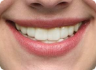 Our products | instasmile snap-on veneers