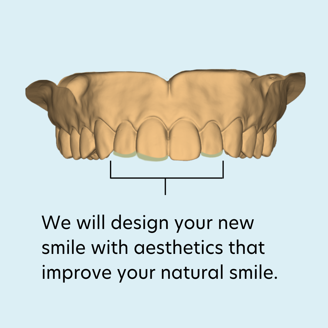 Our products | instasmile snap-on veneers