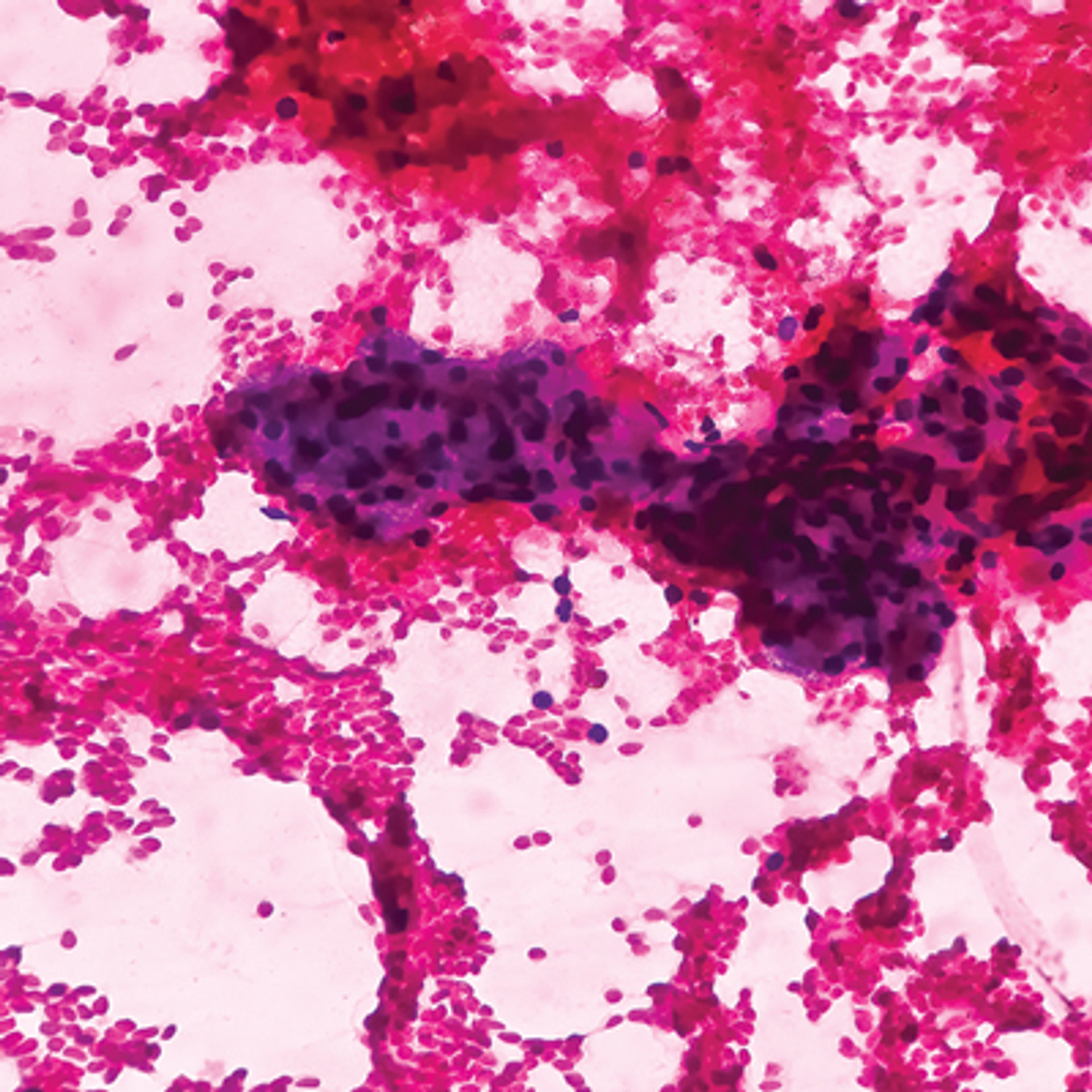 Advances In Cytology And Small Biopsies