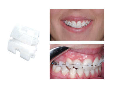 Bracket cerâmico Aqua™ - Dental de Venta Directa SA (PT) - B2B Dentaleader