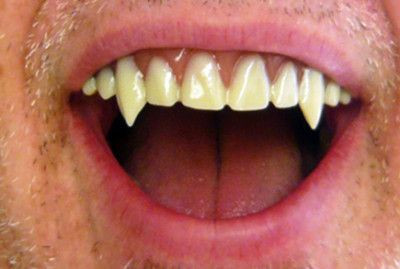 Dental Distortions Evil Clown Teeth Pennywise Grimm Grell Orc Minion ...