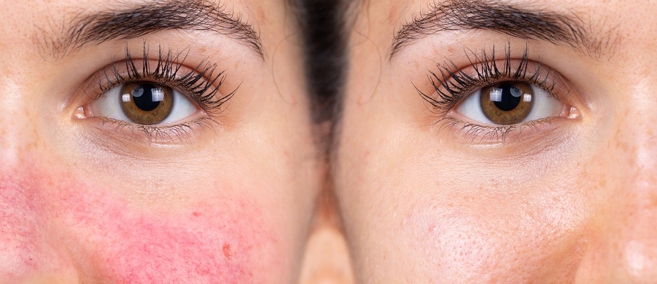 April is Rosacea Awareness Month - beautystoredepot.com