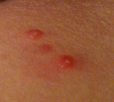 Molluscum Contagiosum at Home Treatment for Children: Molluscum ...