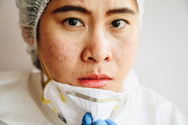 COVID-19 Mask Dermatitis and Emu Oil - AllAboutEmu