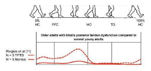 Beat Posterior Tibial Tendonitis - How Orthotics Can Help - Orthotics ...