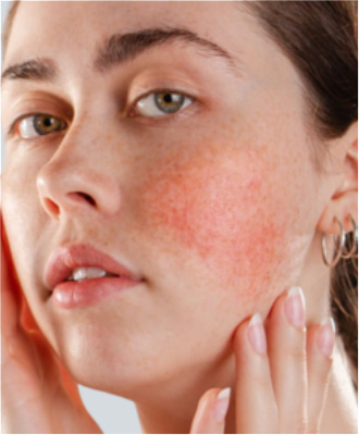 Rosacea