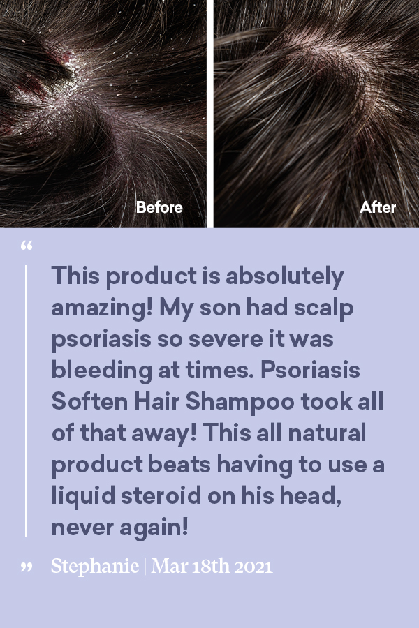 Psoriasis Soften Hair Duo – Calm Scalp Irritation & Moisturize Dry Hair ...