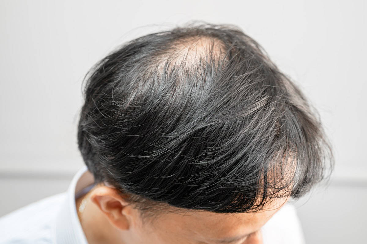 The Science Behind Hair Thinning: What You Need to Know - Xandrox