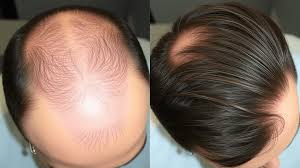 Why Is My Hair Falling Out? The Real Causes of Thinning & Balding Hair ...