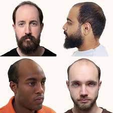 Understanding Hair Balding - Xandrox