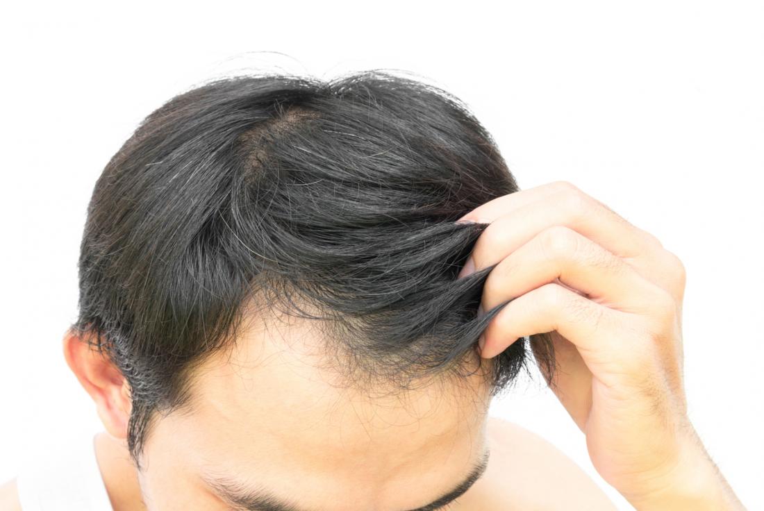 Hair Thinning Remedies: Regain Confidence and Control - Xandrox