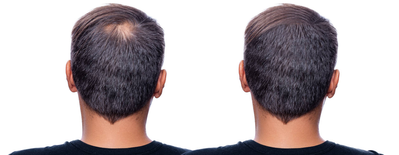 From Scalp to Strand: The Journey of Hair Growth - Xandrox