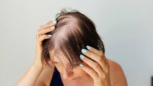 The Best Hair Loss Treatment for Women: Achieving Thicker, Fuller Hair ...