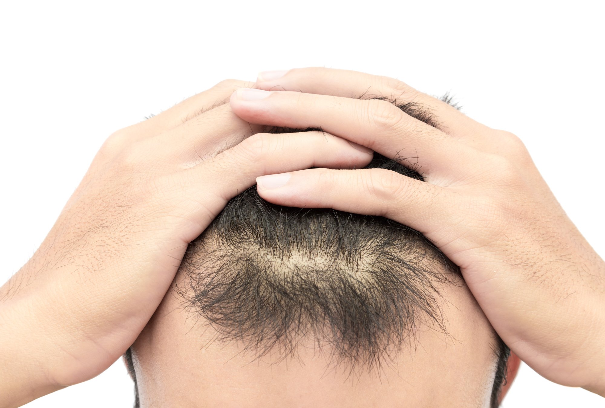 The Best Hair Loss Treatment for Men: Regrow Your Hair with Minoxidil ...