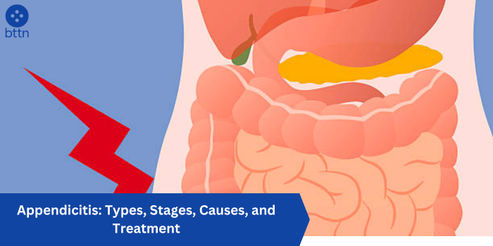Appendicitis: Types, Stages, Causes, and Treatment - bttn