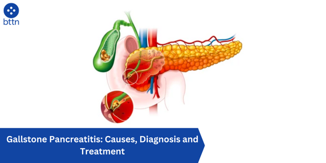 Gallstone Pancreatitis: Causes, Diagnosis and Treatment - bttn
