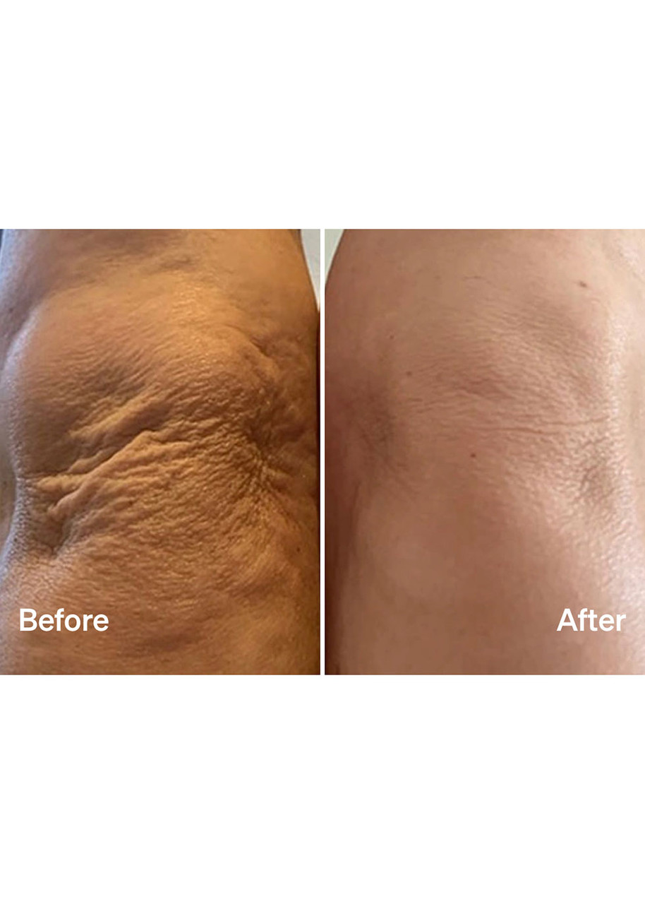 LYMA Laser Mist & Glide Refill 60 Days | Harvey Nichols