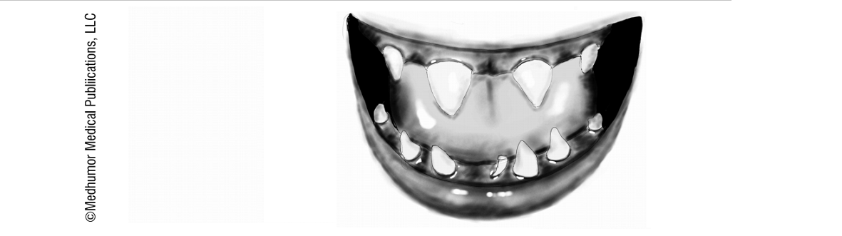 Pediatric Board Review : 5 Signs of Hallerman-Streiff - Laughing Your ...