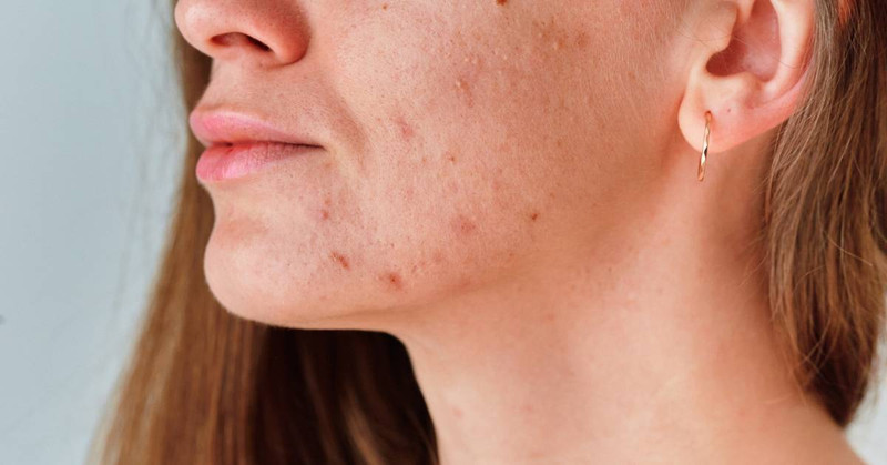 A Brief Overview Of The Connection Between Dry Skin And Acne Jil