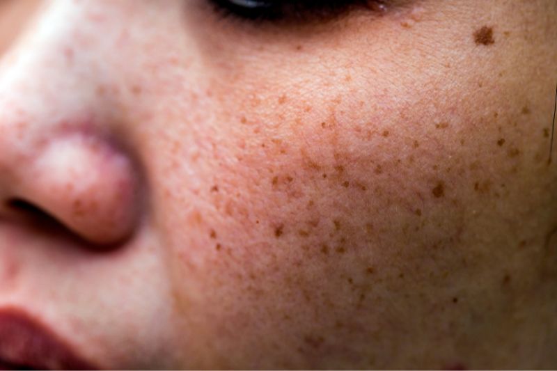 Hyperpigmentation: What Are the Dark Spots on Your Skin? - Jil Goorman ...