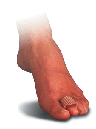 Hammertoe Causes, Treatment & Relief | Orthotic Shop