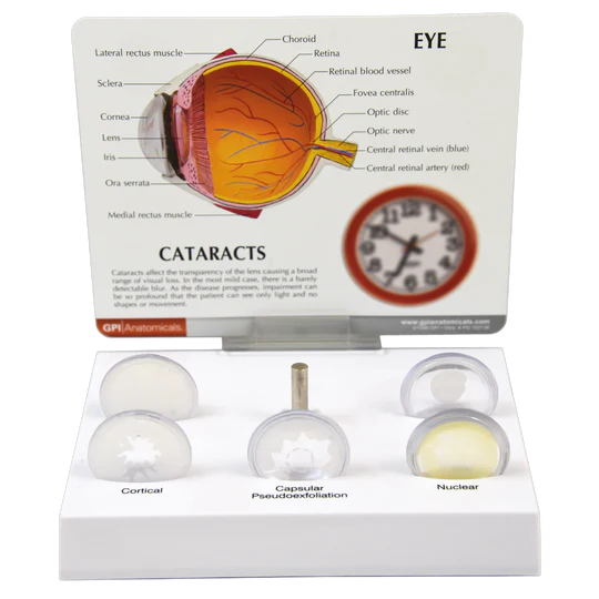 Eye Model, Cataract - accuspire