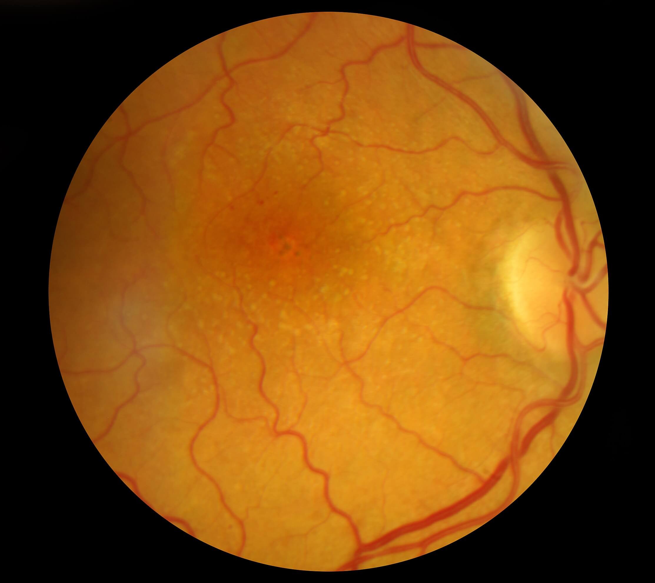 Branch Retinal Vein Occlusion And Its Symptoms - accuspire