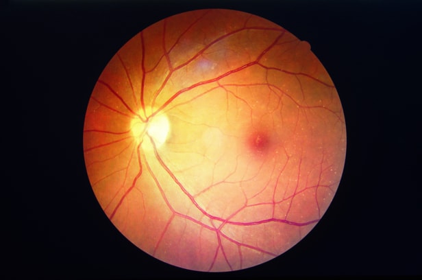 Diabetic Retinopathy And Its Types - accuspire
