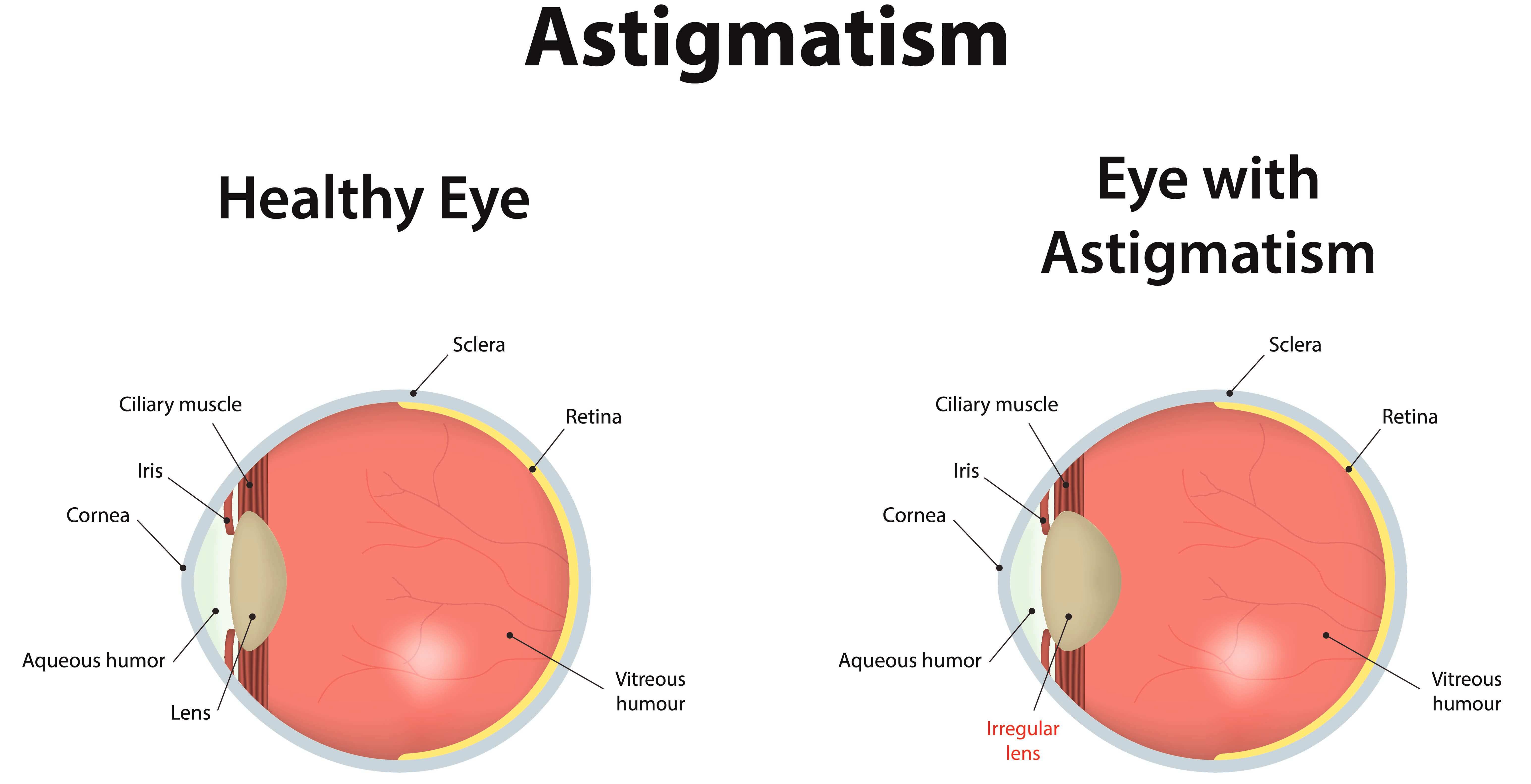 Astigmatism - Causes And Types - accuspire