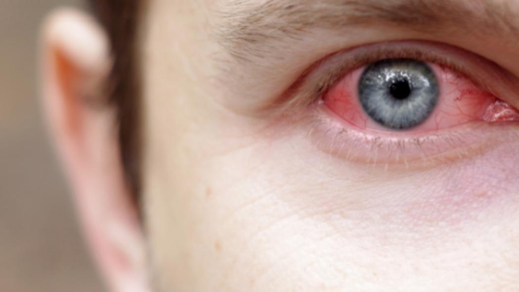 Redness Relieving Eye Drops - accuspire