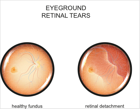 Retinal Tear and Detachment - accuspire