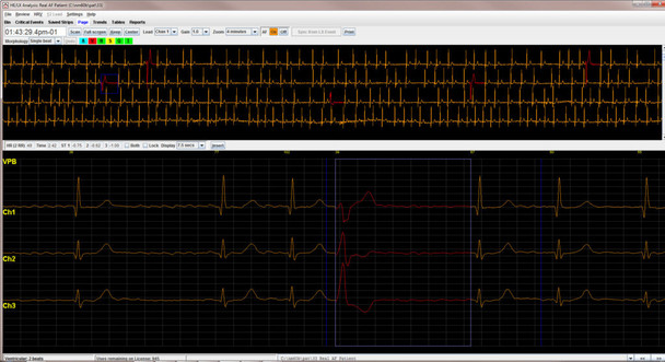 NorthEast Monitoring DR400 Patch H/E + HELX® Analysis Holter Software