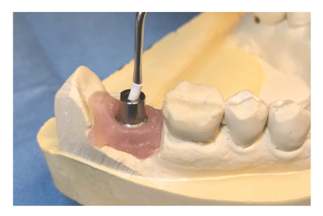 i-PLUG Implant Abutment PTFE Fillers | AD Surgical