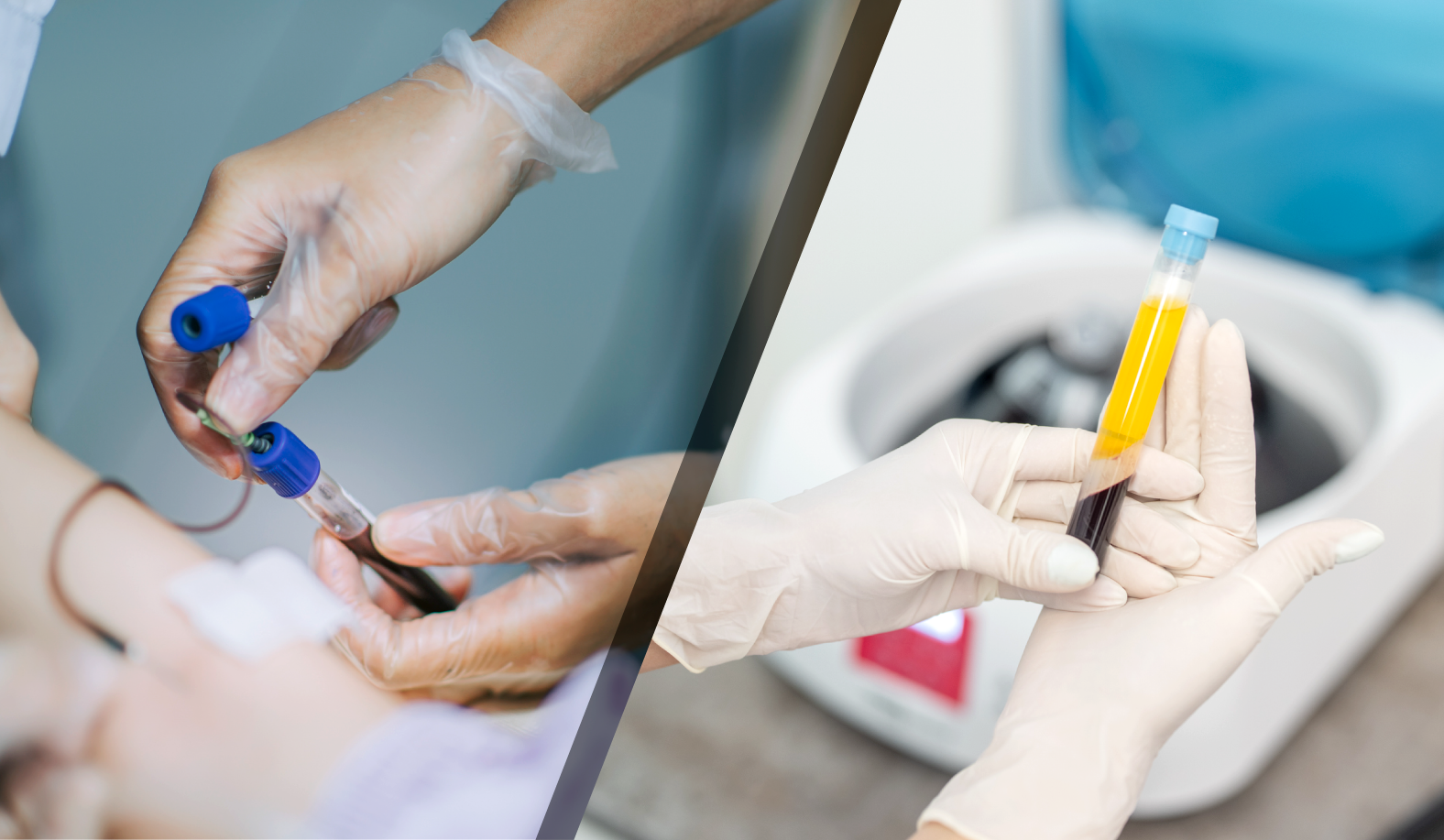 Unveiling PRP: The Science Behind Its Surge in Popularity - AD Surgical