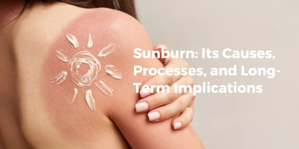 What isSunburn?