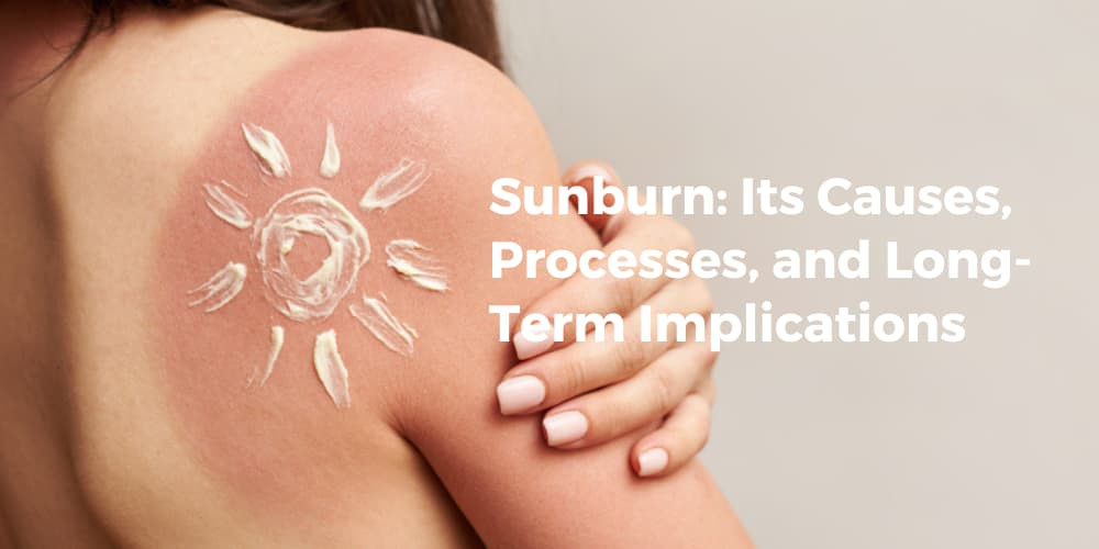 What isSunburn?
