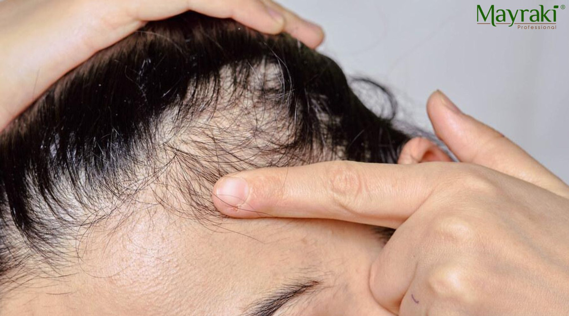 Understanding Receding Hairline Mayraki