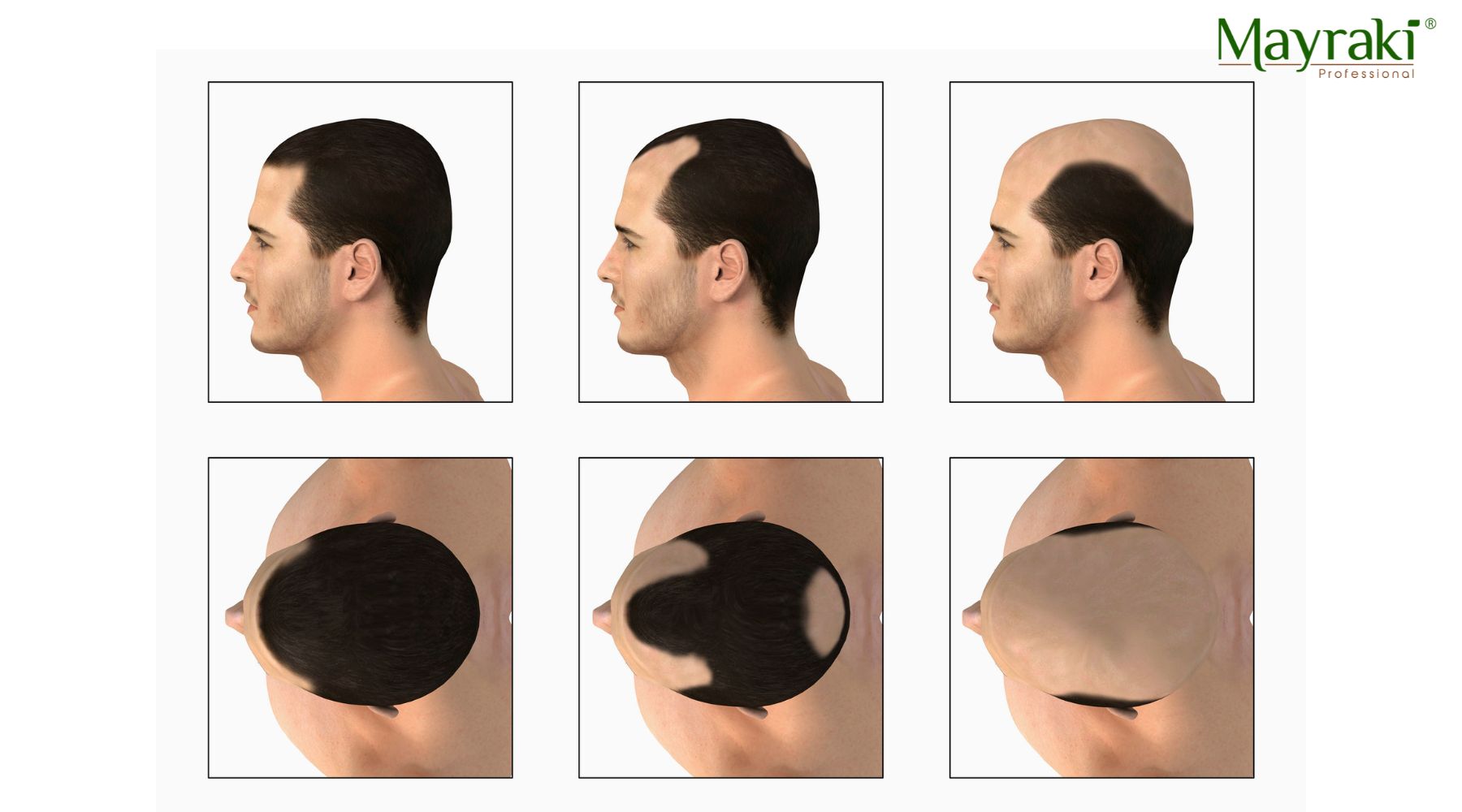 Understanding Male Pattern Baldness Causes And Solutions Mayraki