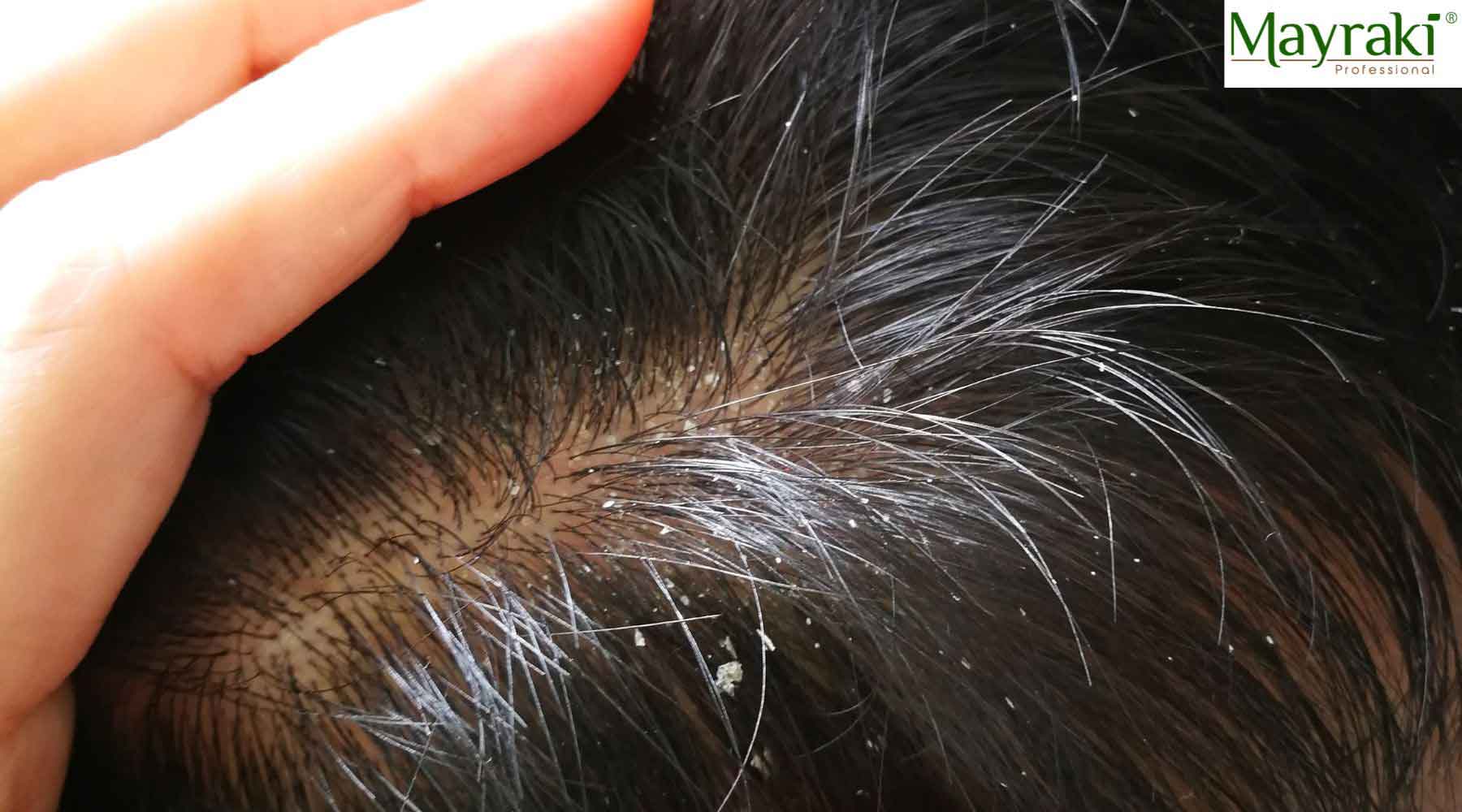 What Is Dandruff: Causes and Treatments - MAYRAKI