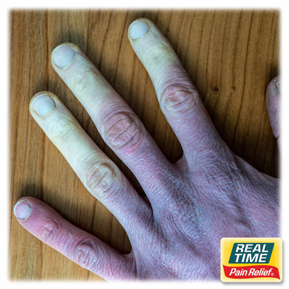 Raynaud’s Phenomenon: Finding Warmth and Comfort with Nature’s ...