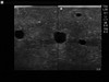Branched 4 Vessel Ultrasound Training Block Model