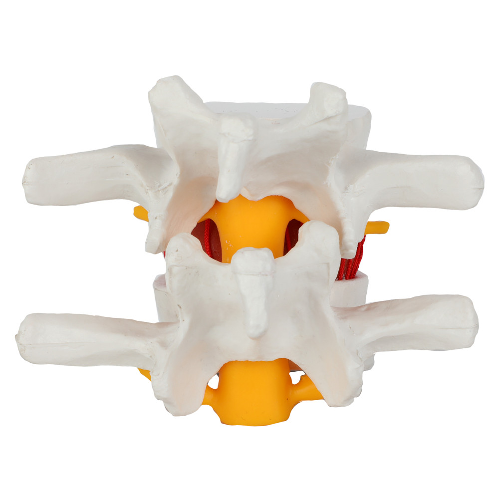 Axis Scientific - Human Lumbar Herniating Disc Demonstration Anatomy Model