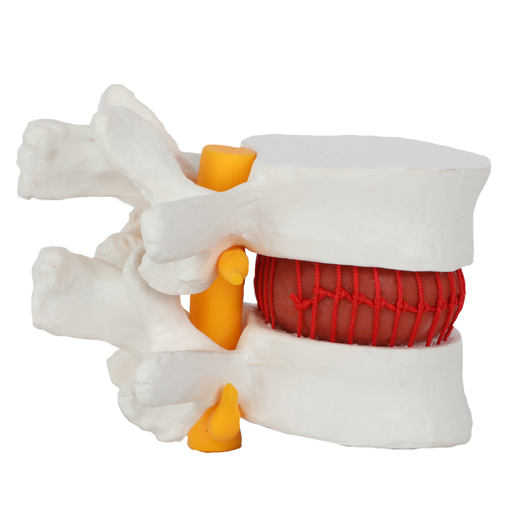 Axis Scientific - Human Lumbar Herniating Disc Demonstration Anatomy Model