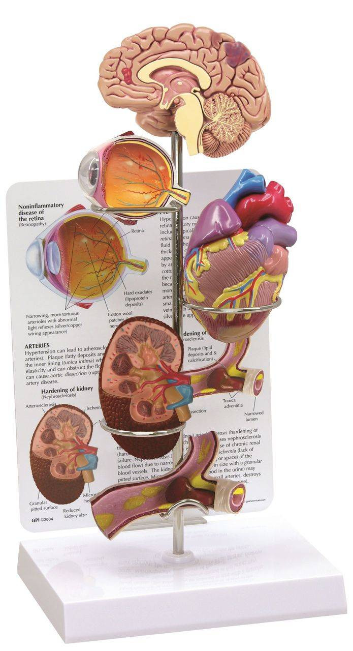 Anatomy Model Diabetes Type 2