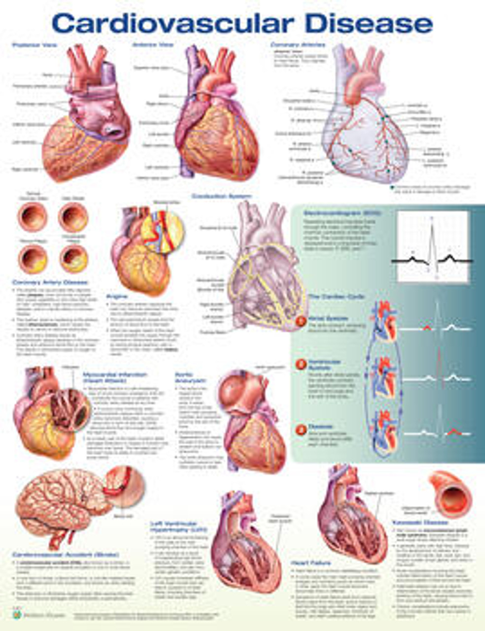 Wolters Kluwer Cardiovascular Disease Laminated Anatomical Chart wolters-kluwer-cardiovascular-disease-laminated-anatomical-chart